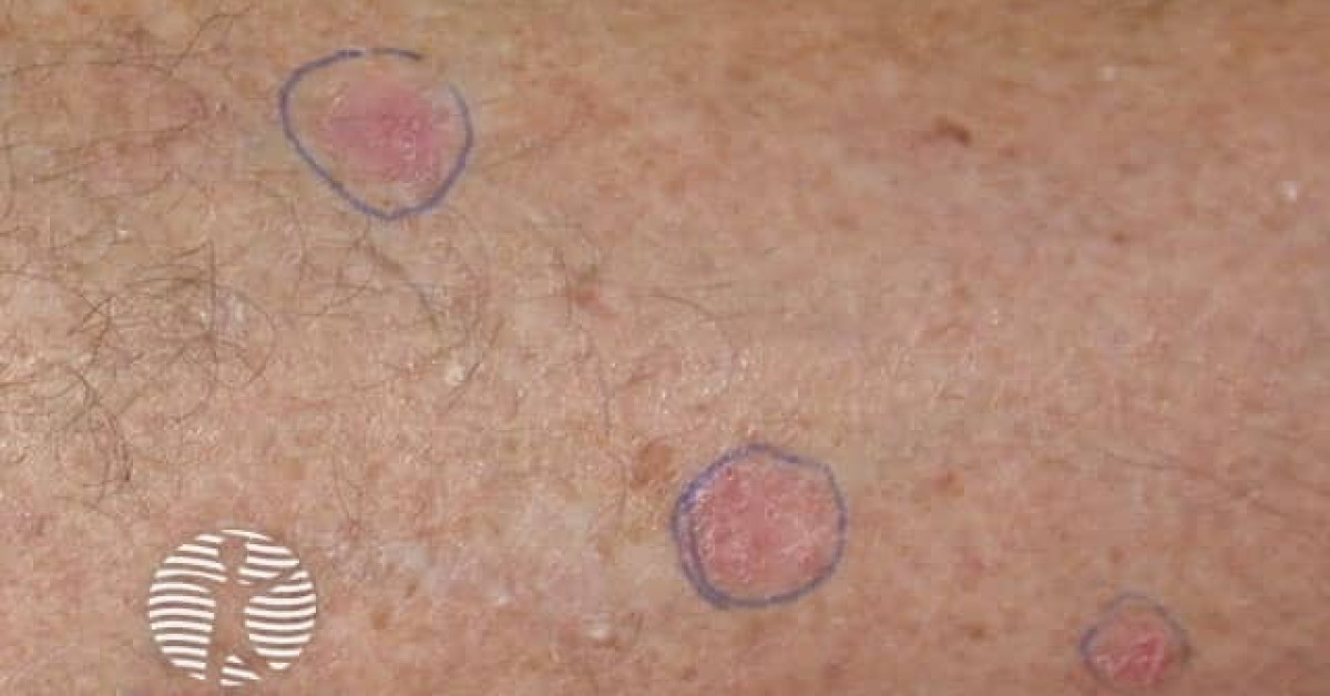 Skin cancers image