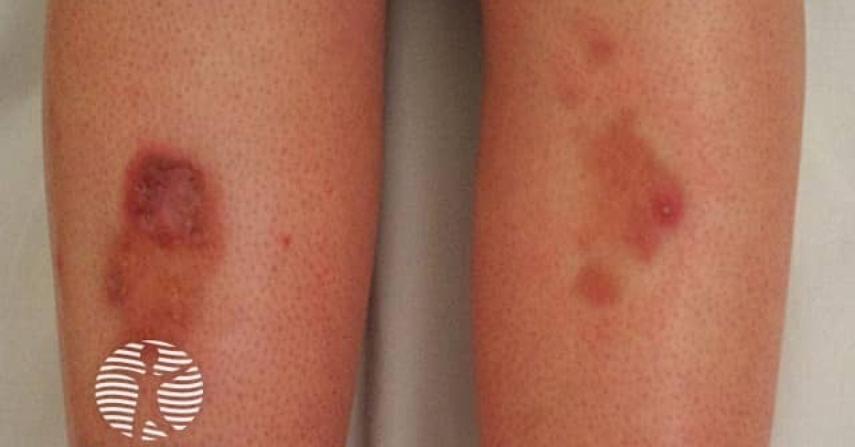 Necrobiosis lipoidica image