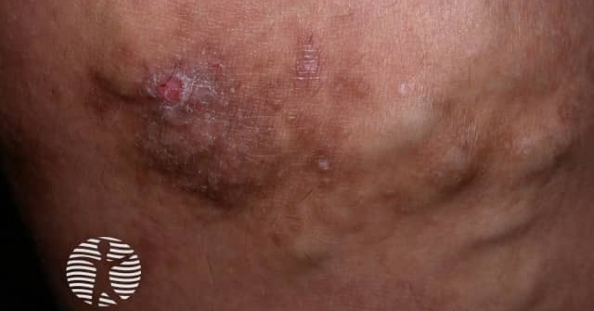 Varicose dermatitis image