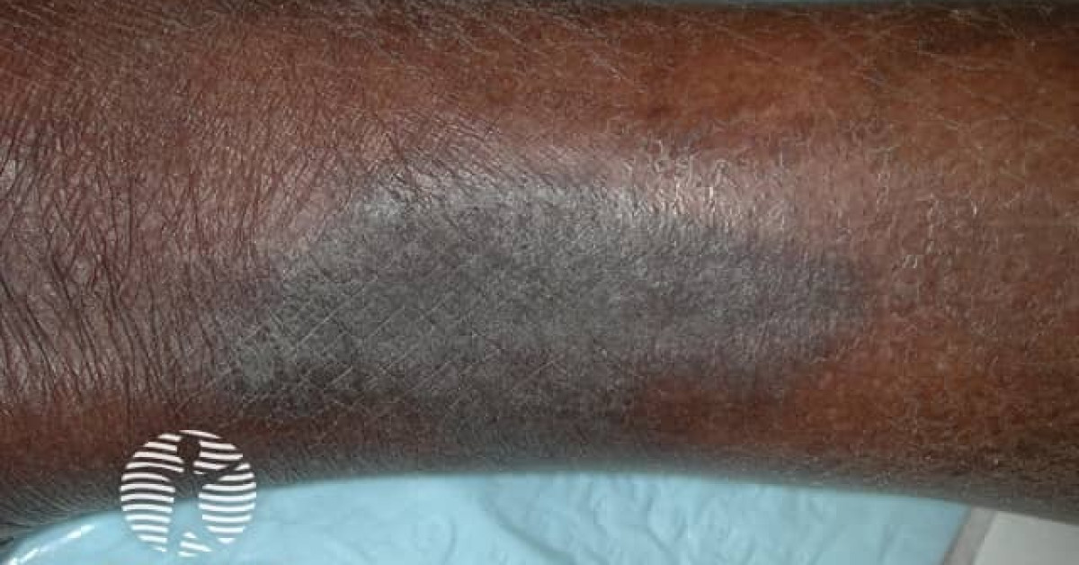 Lichen simplex image