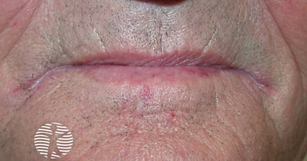 Angular cheilitis image