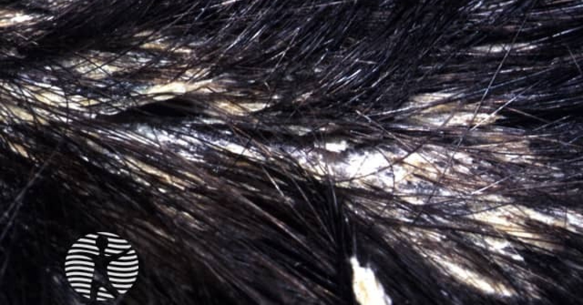 Pityriasis amiantacea image