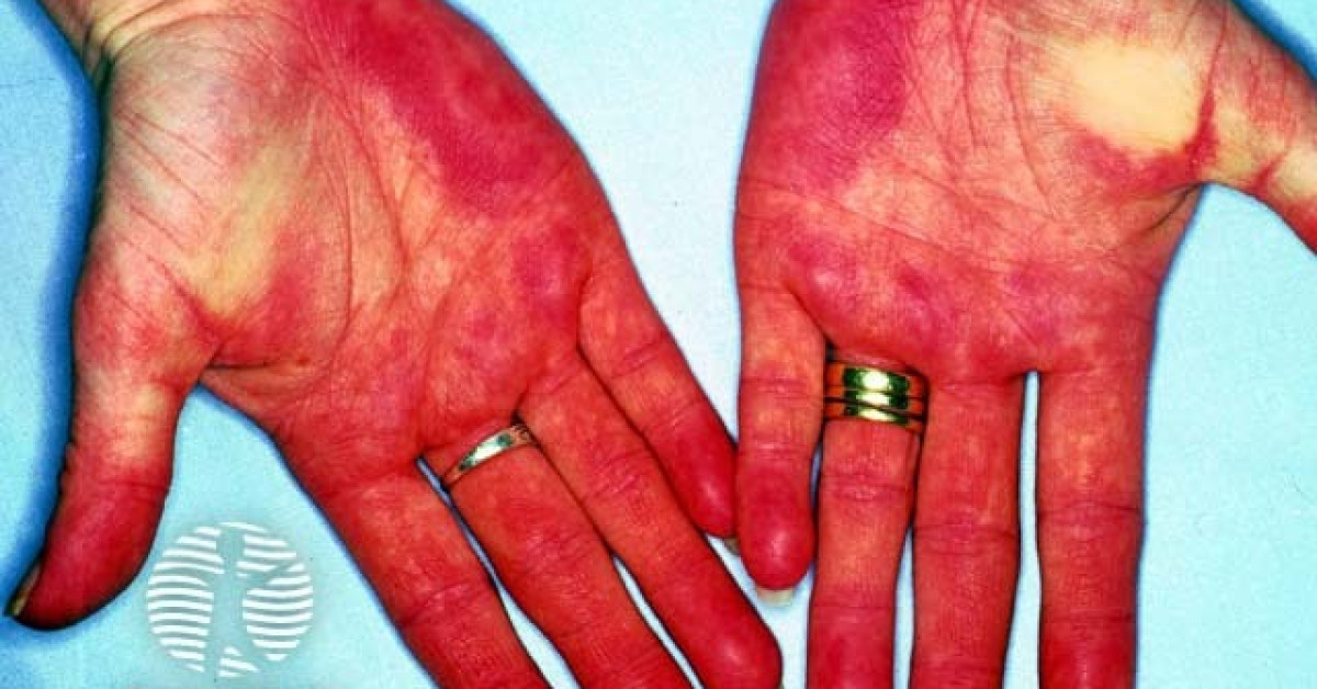Palmar erythema image