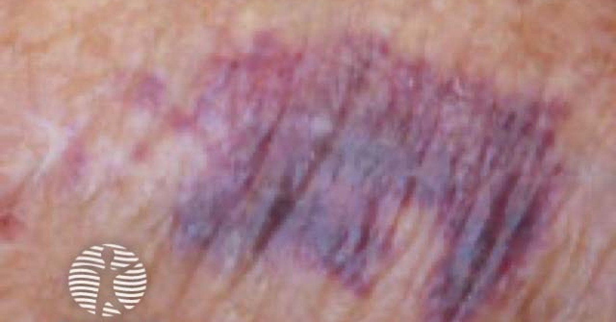 purpura s image