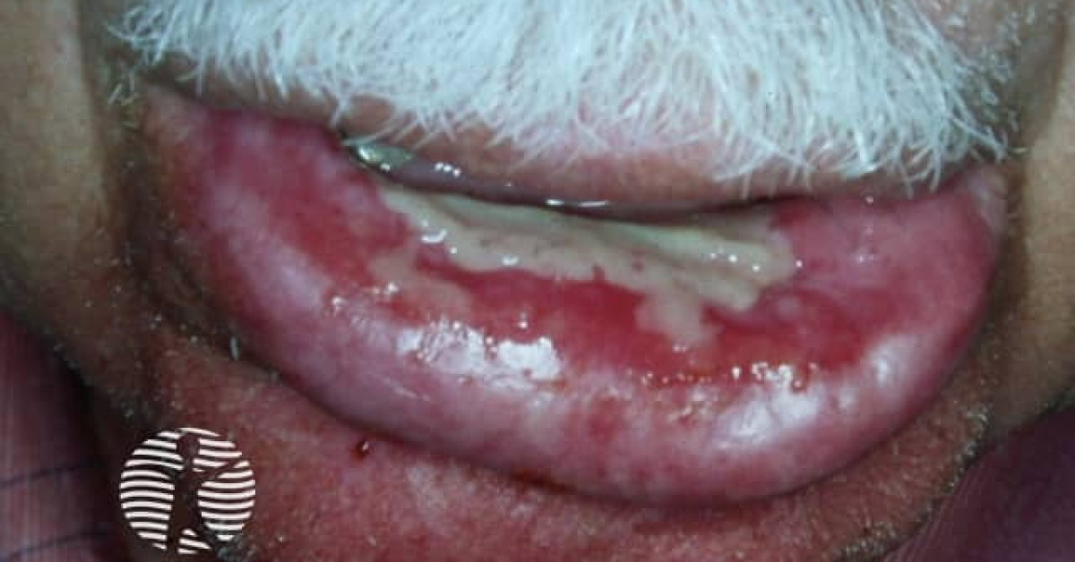 Radiation-induced stomatitis image