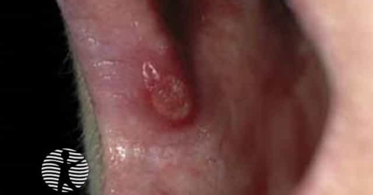 Aphthous ulceration image