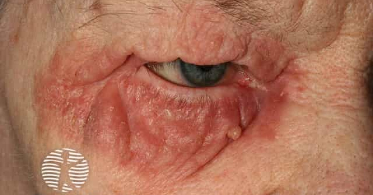 Blepharitis associated with seborrhoeic dermatitis image