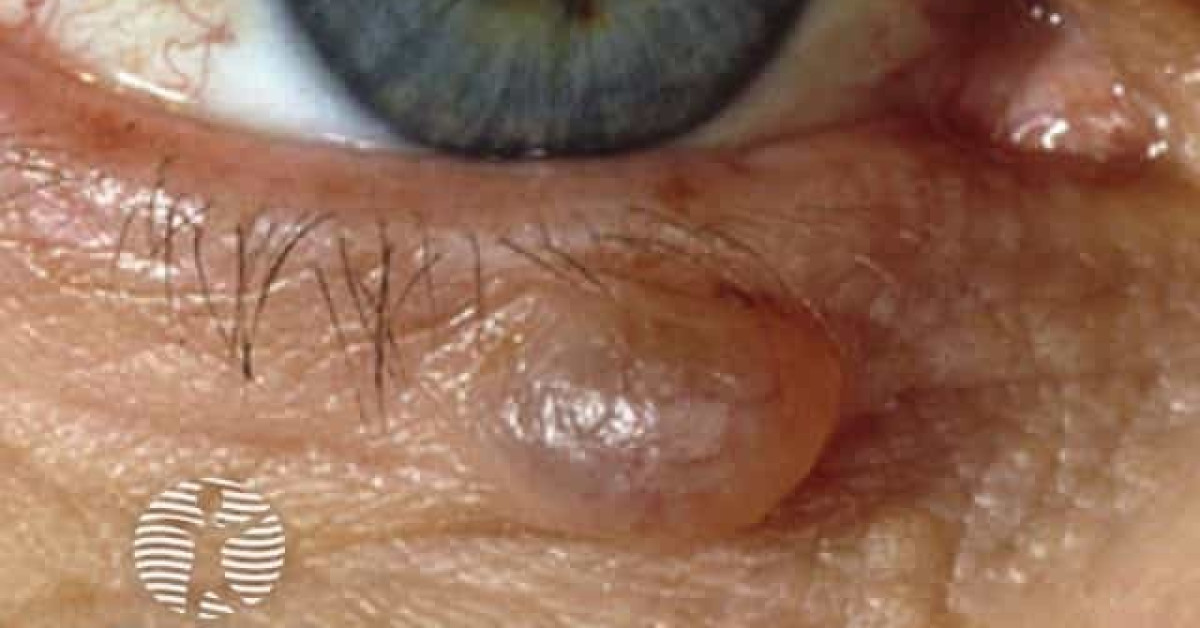Eyelid subdoriferous cyst image