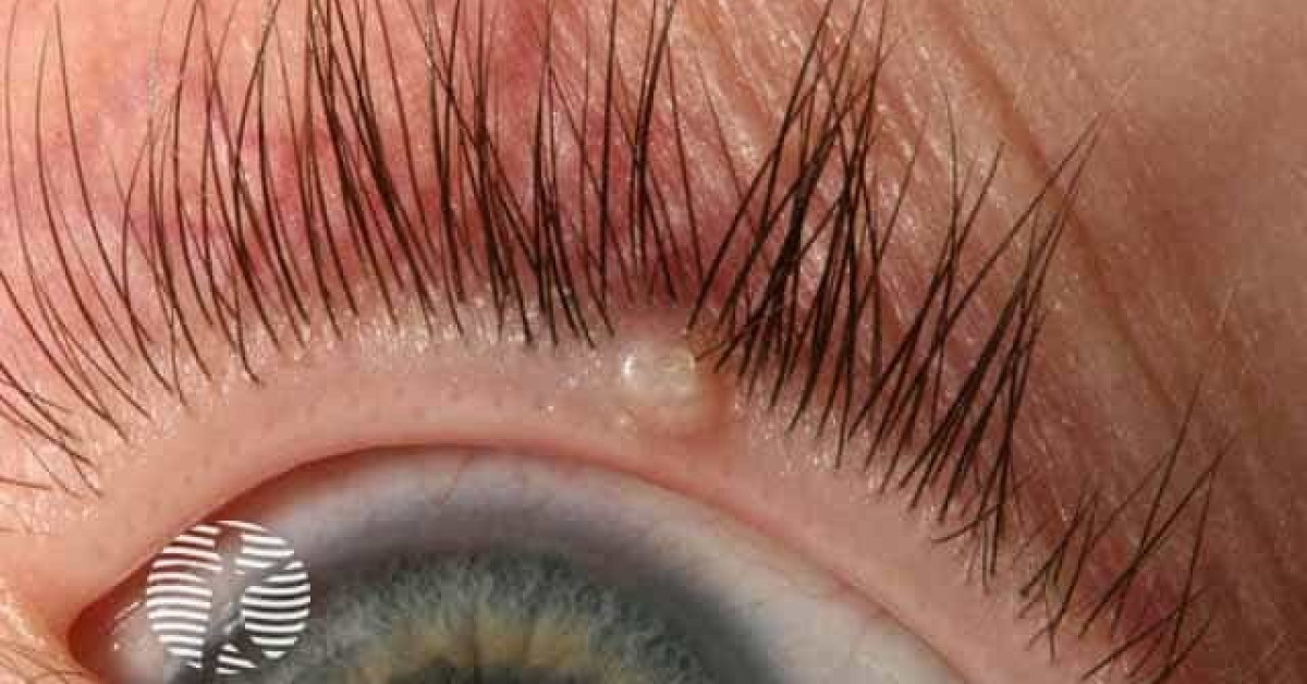 Eyelid molluscum contagiosum image