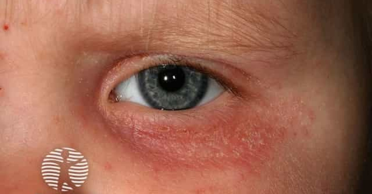 Eyelid atopic eczema image