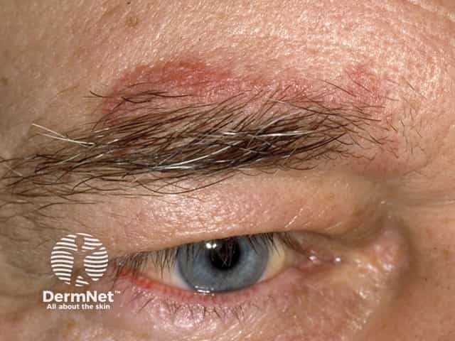 Seborrhoeic Dermatitis Eyebrows Seborrhoeic Dermatitis Eyebrows