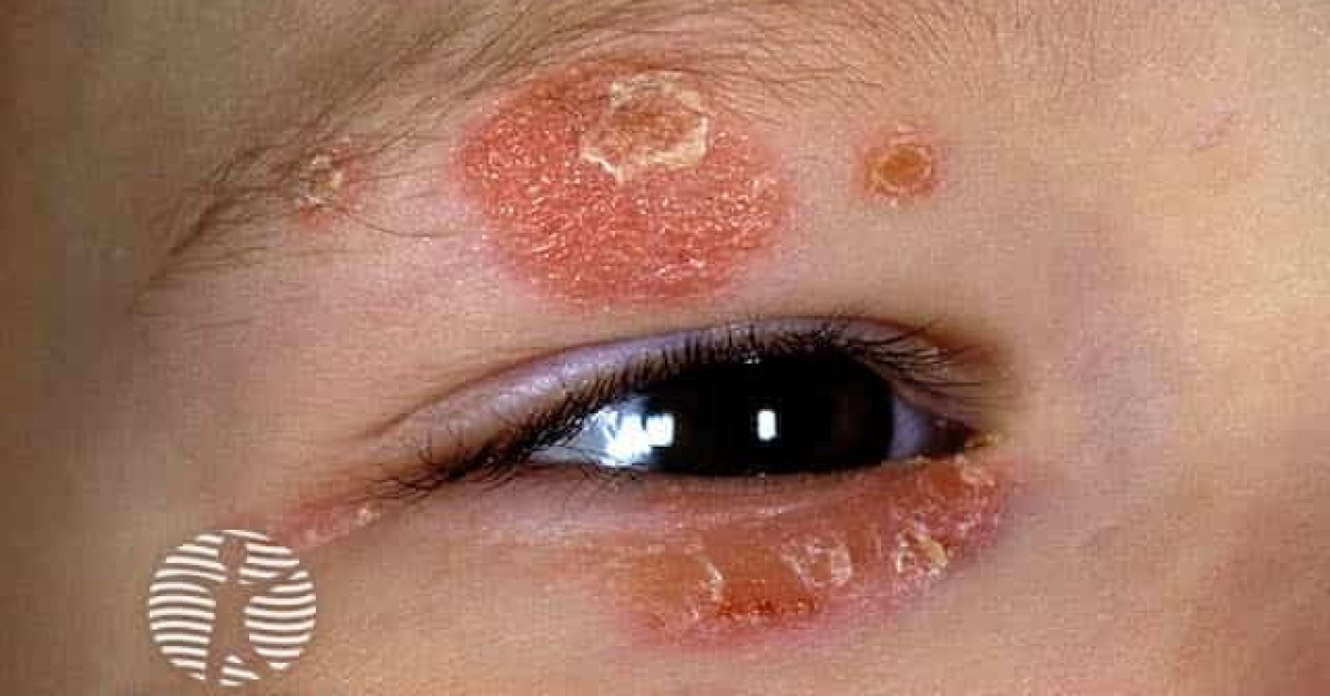Eyelid psoriasis image