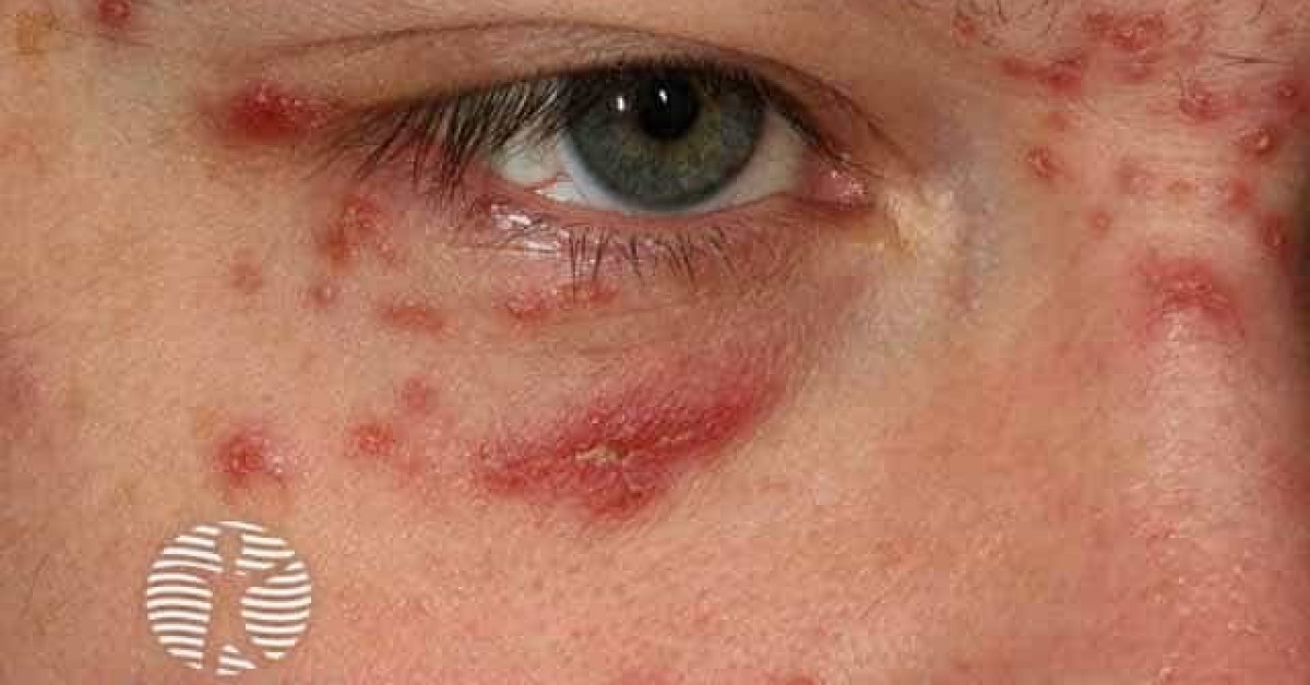 DermNet® - Acne agminata around eyelid image