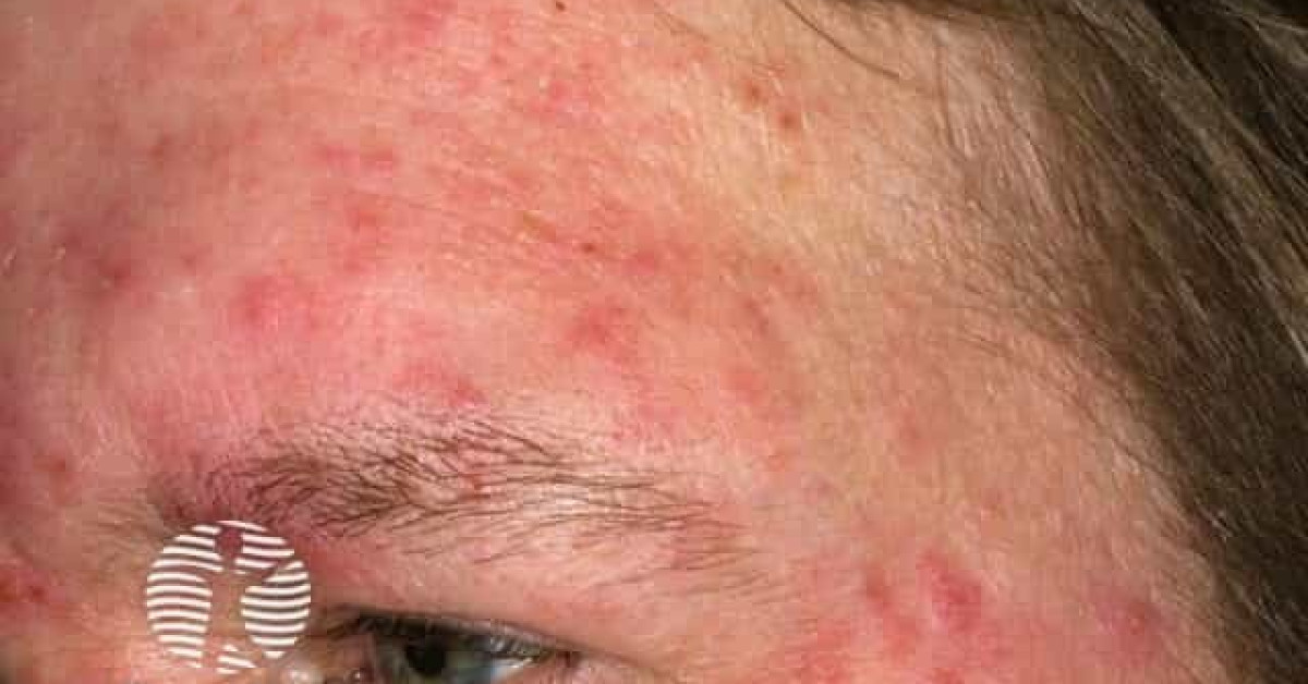 Rosacea around eyelid image