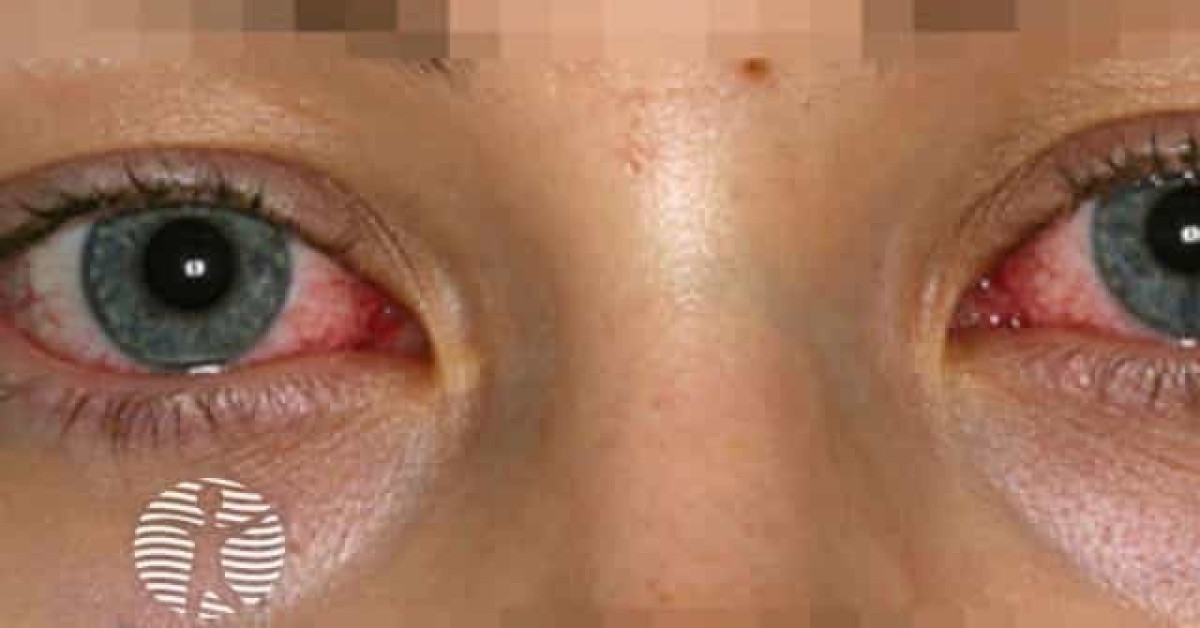 Eye involvement in Stevens Johnson syndrome image