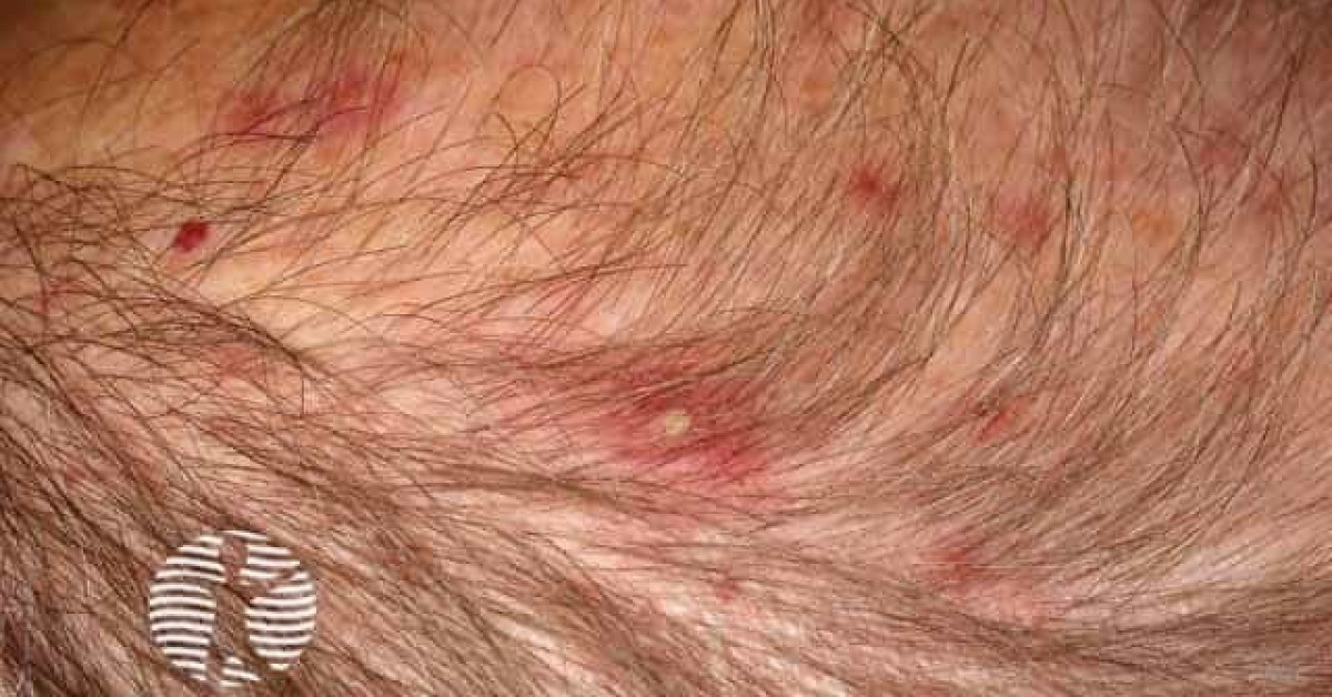 Scalp folliculitis image