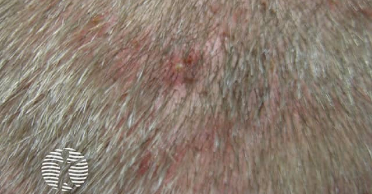 Scalp folliculitis image