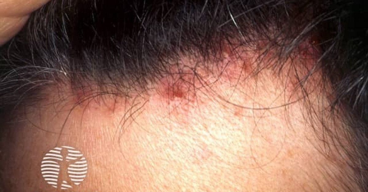 Scalp folliculitis image