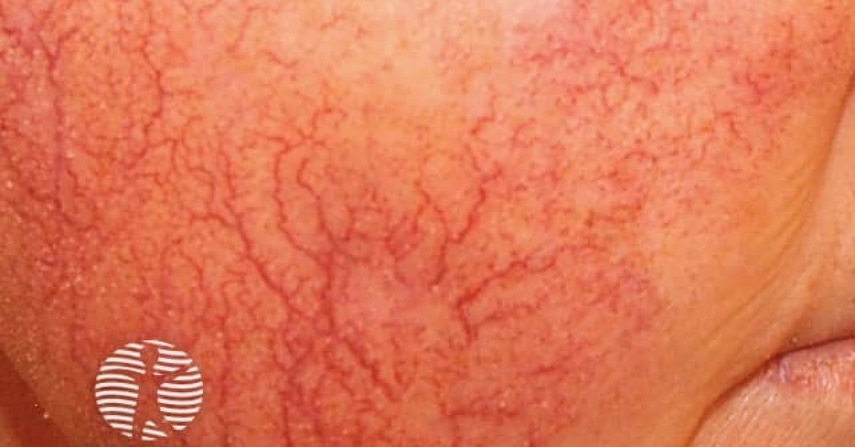 Telangiectasia image