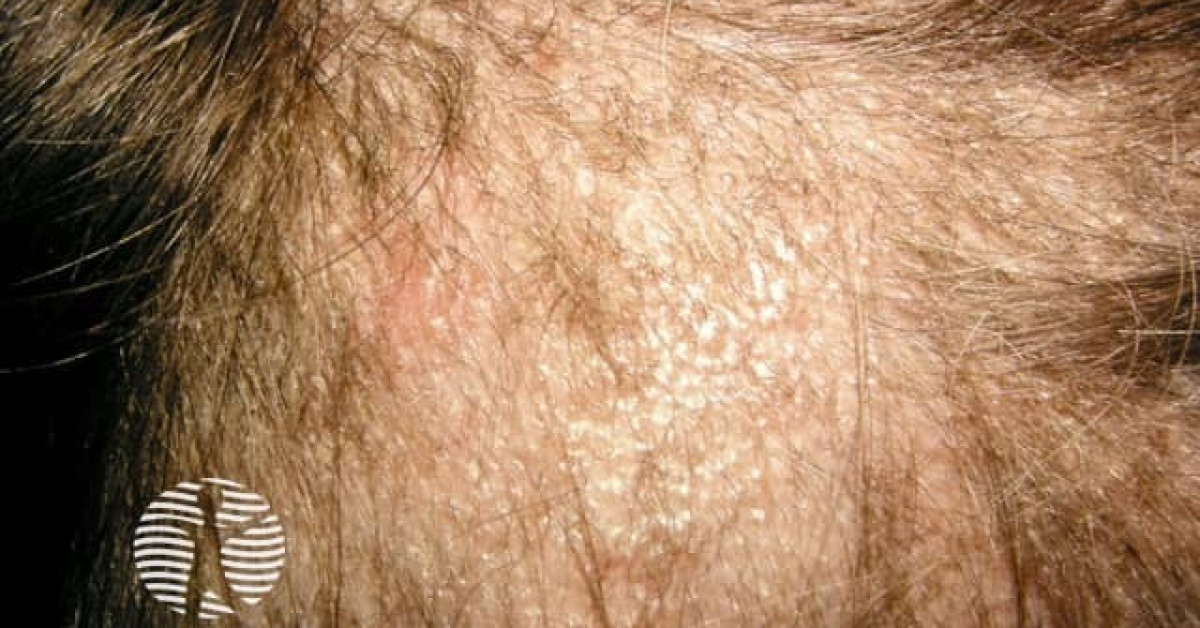 Tinea capitis image