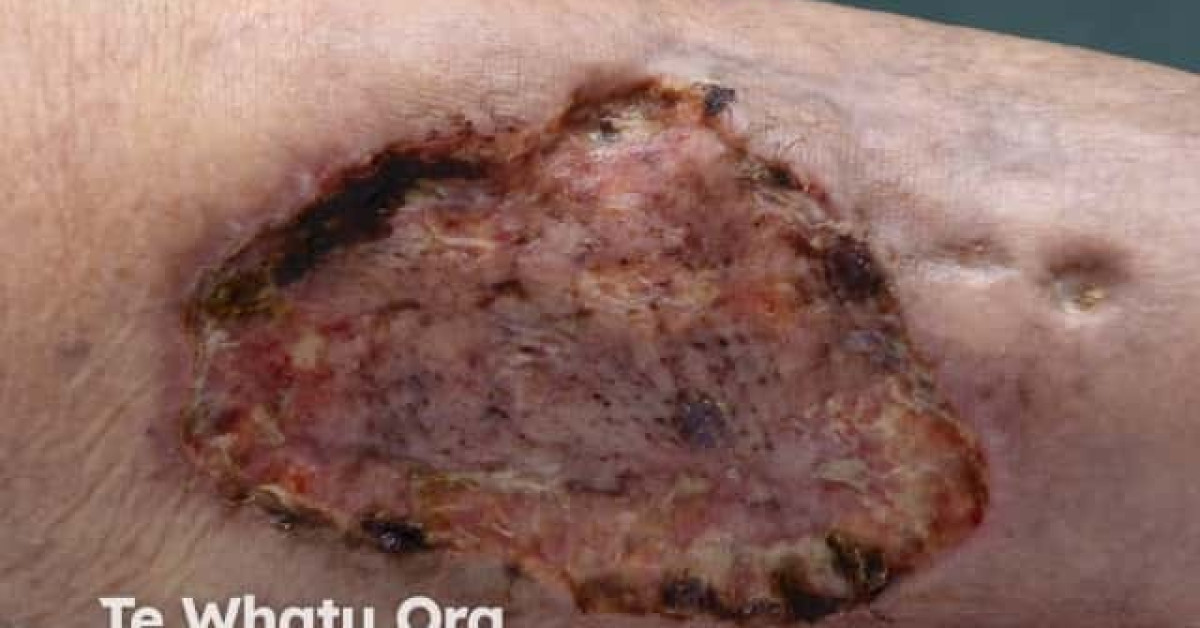 Pyoderma gangrenosum image