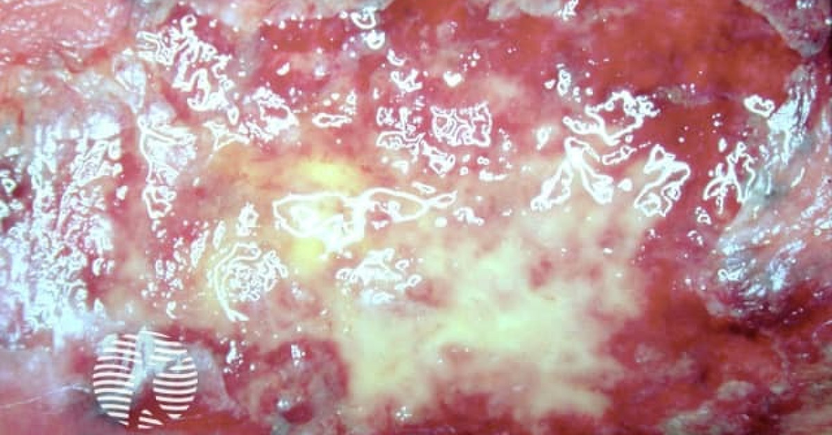 Pyoderma gangrenosum image