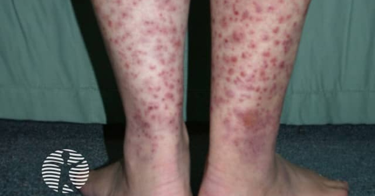 Small vessel vasculitis image