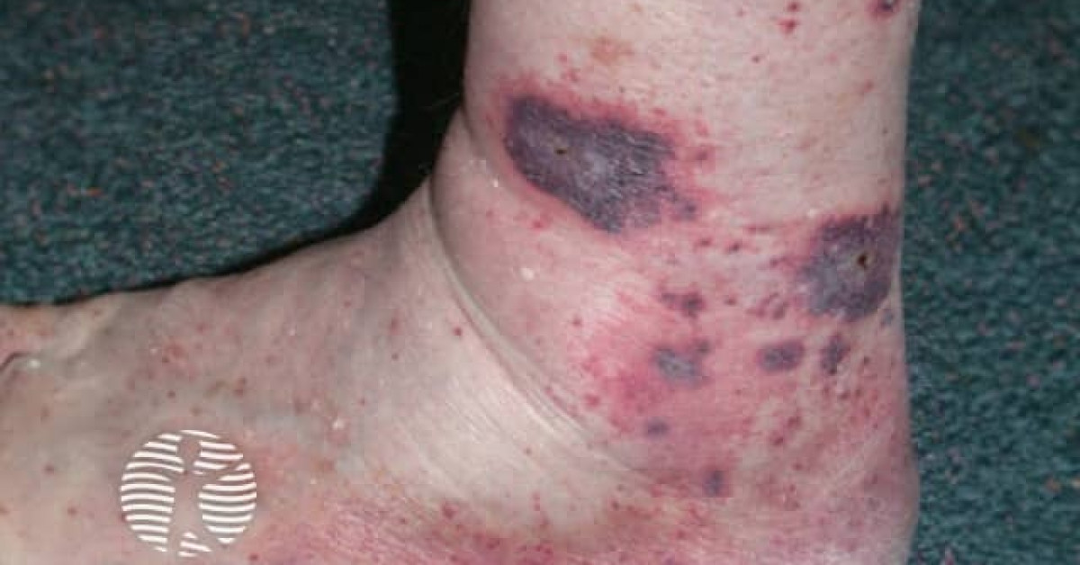 Small vessel vasculitis image
