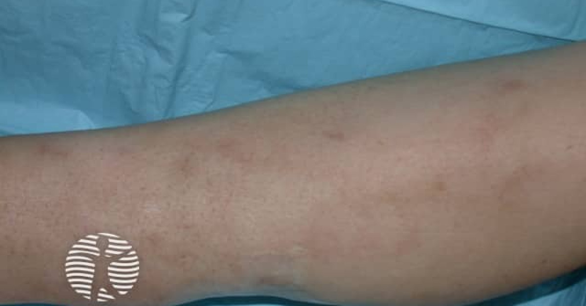 Polyarteritis nodosa image