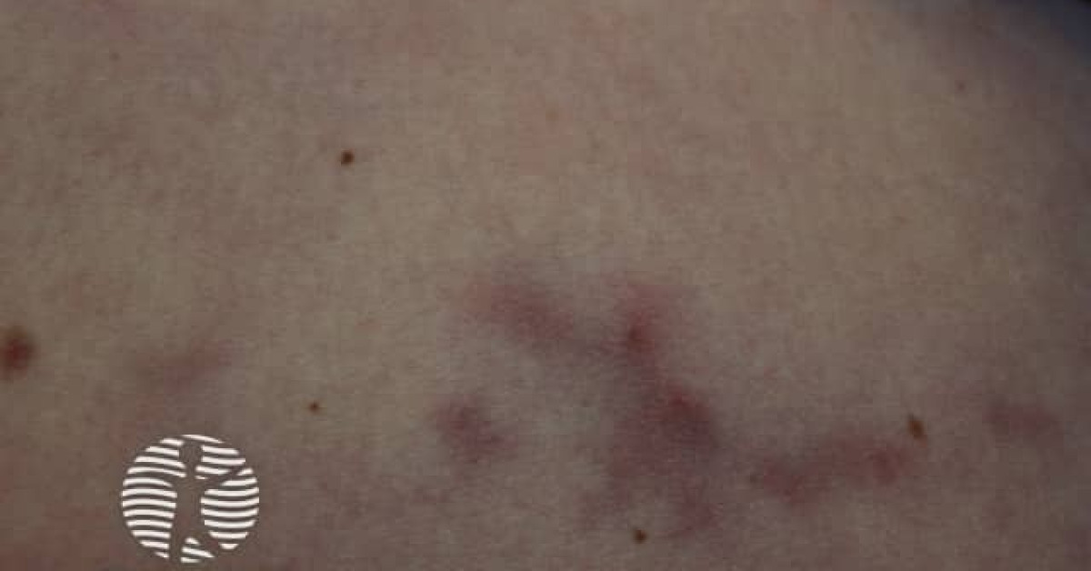 Polyarteritis nodosa image