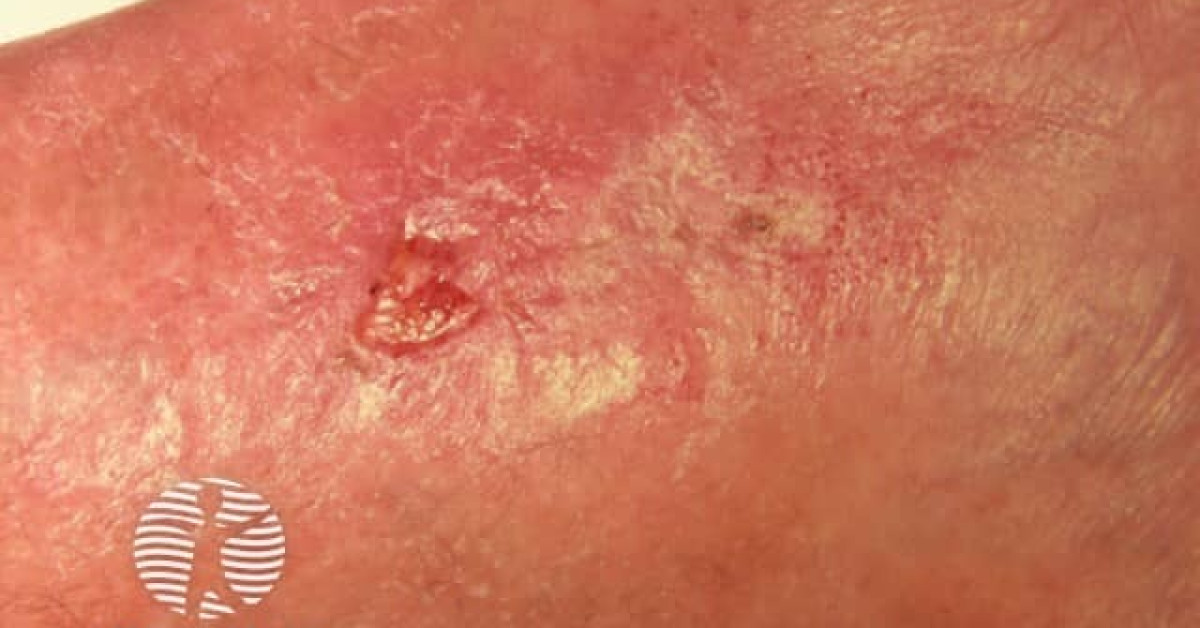 Systemic sclerosis image