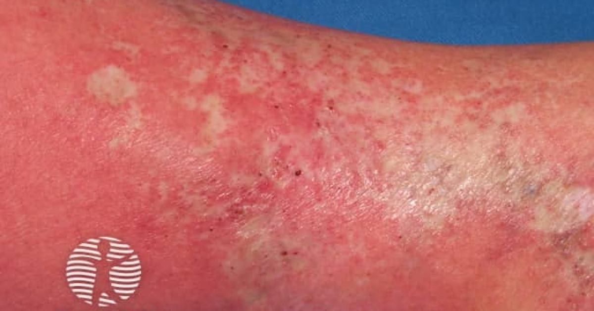 Livedoid vasculopathy image