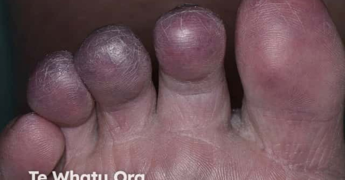 Cholesterol emboli image