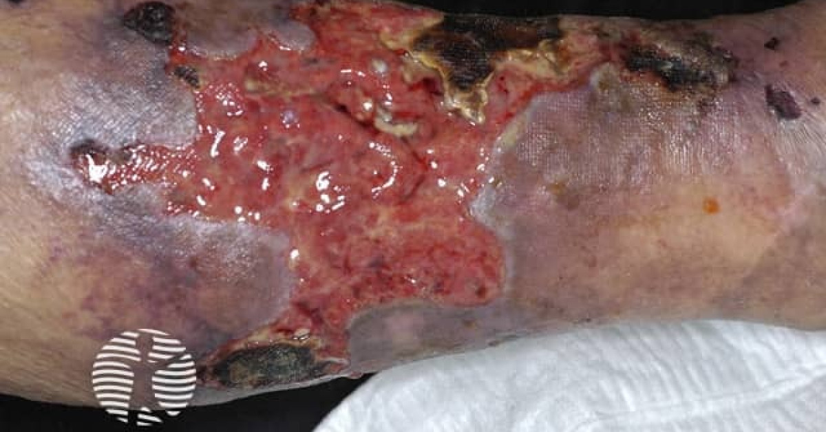 Calciphylaxis image