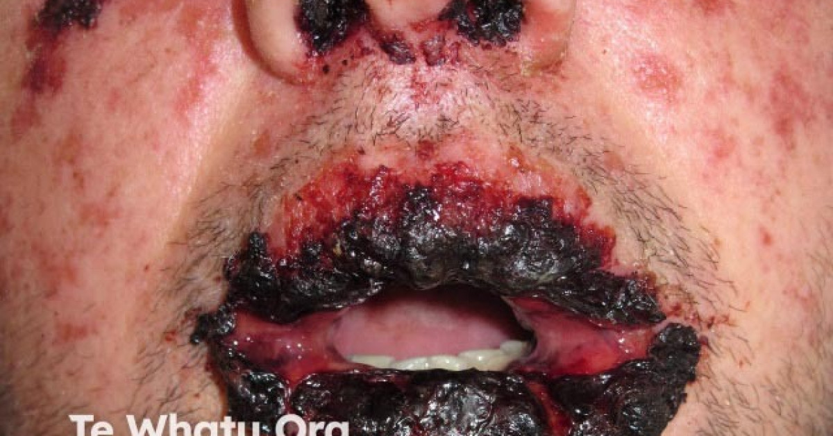 Mucosal involvement in toxic epidermal necrolysis image