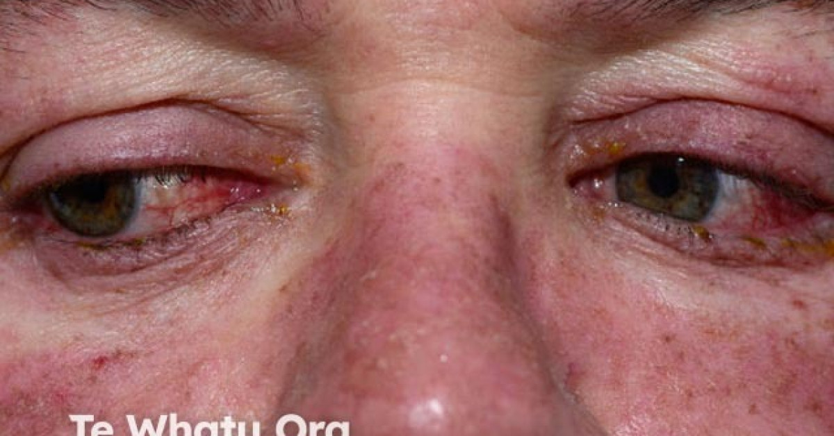 SJS-TEN ocular image