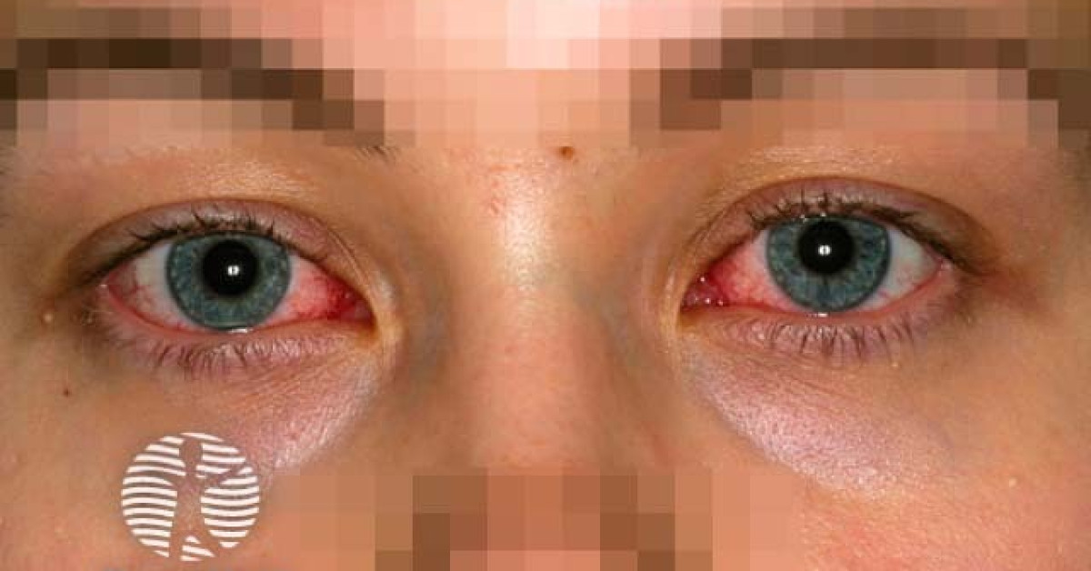 SJS-TEN ocular image