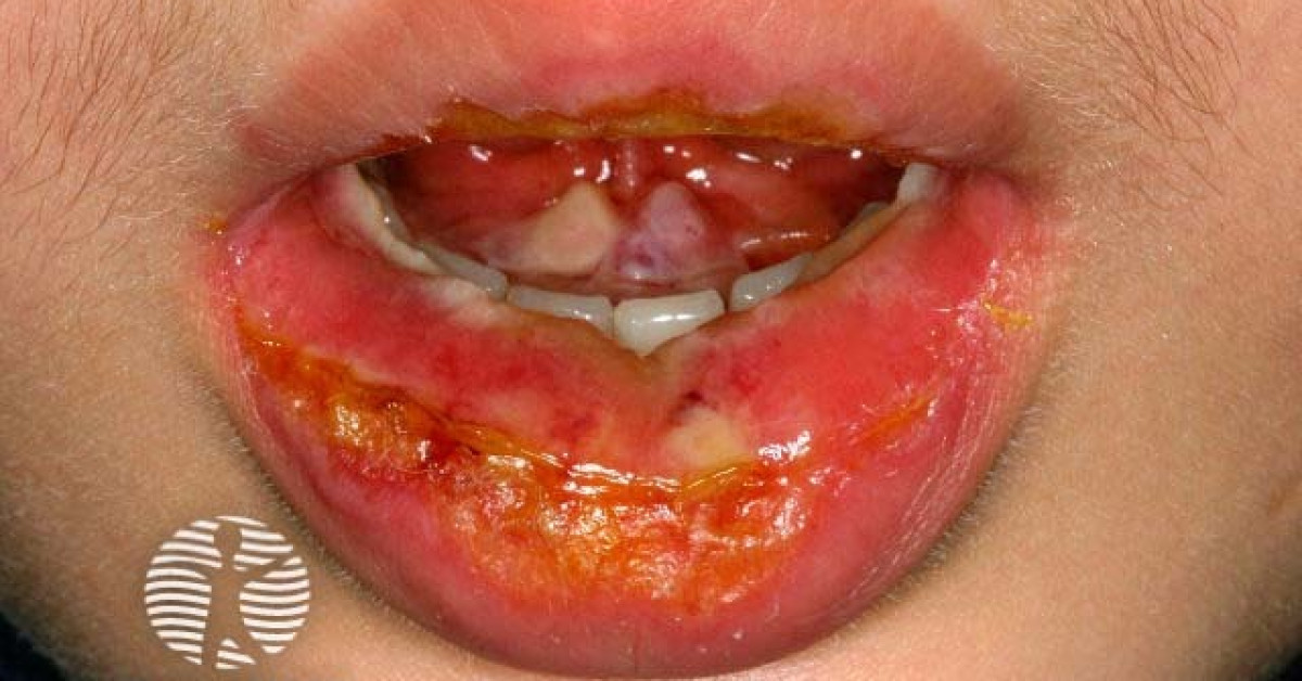SJS-TEN Oral image