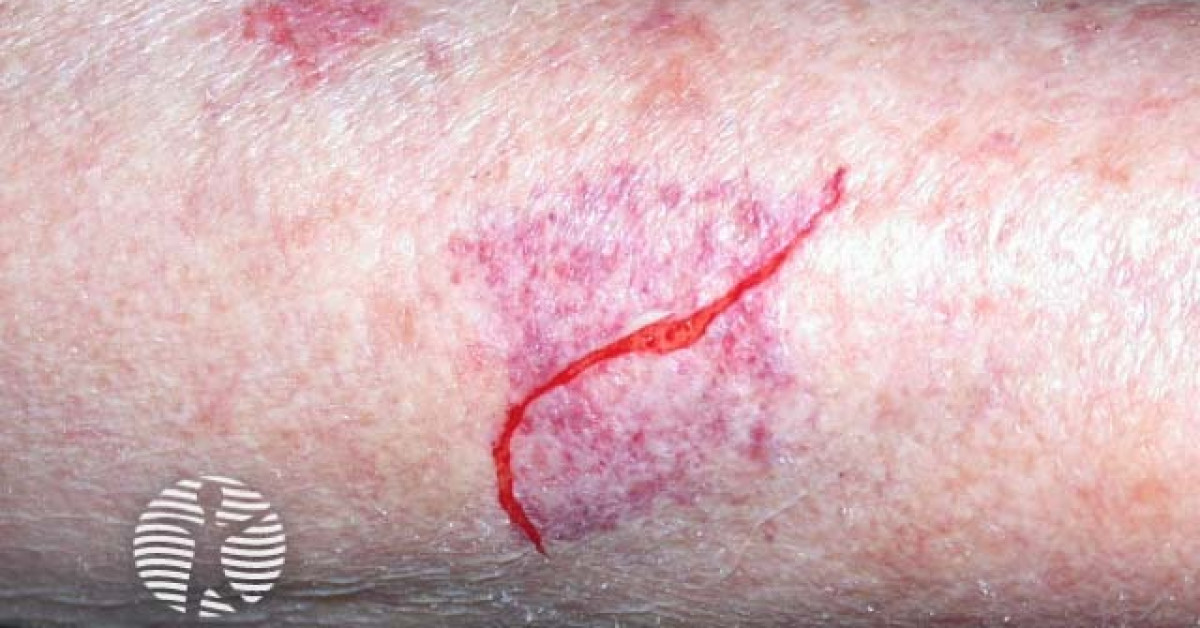 Skin fragility image