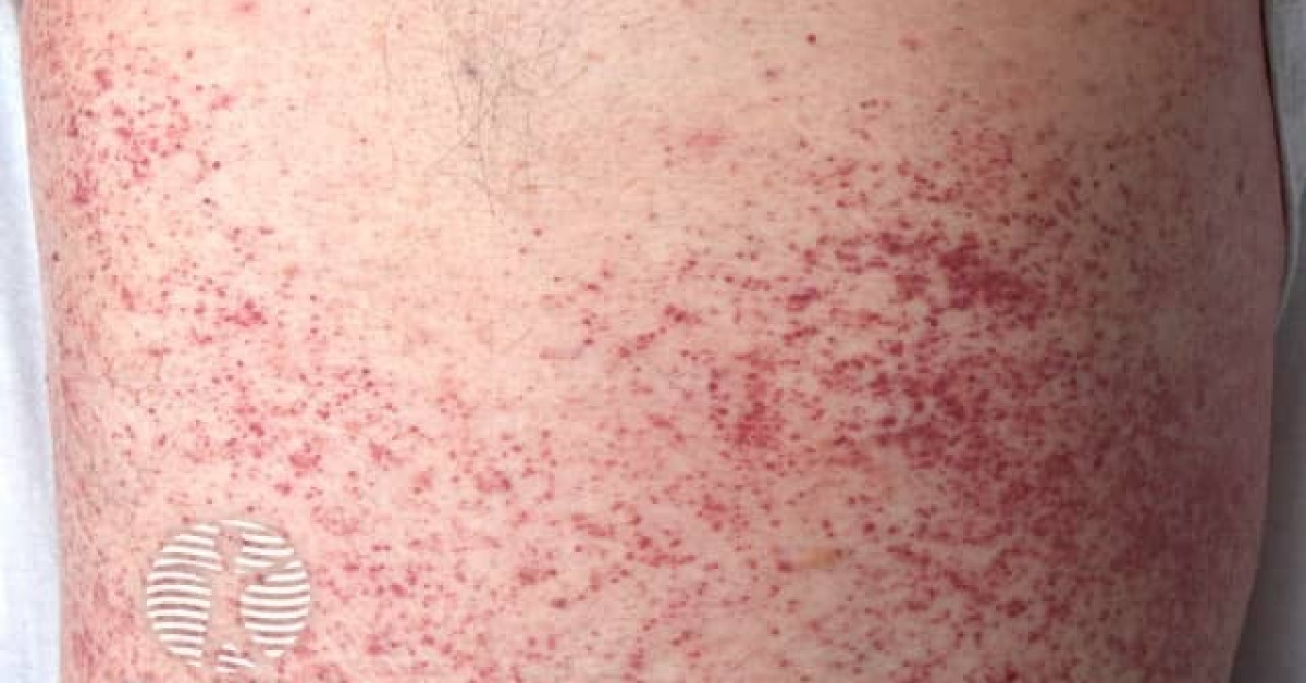 Small vessel vasculitis image