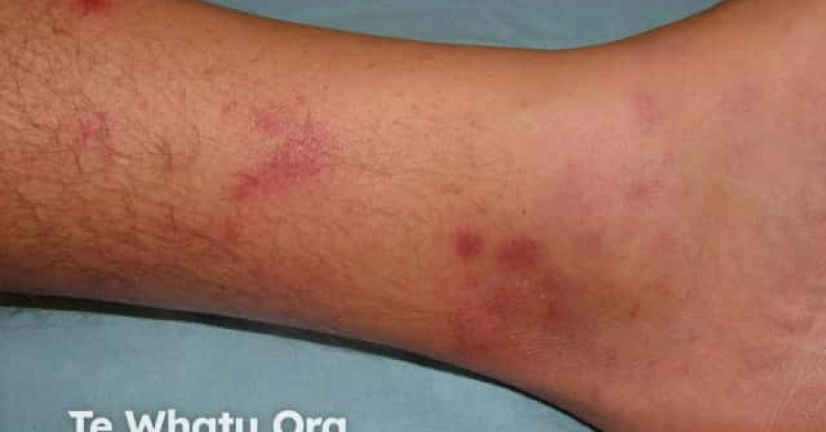 Small vessel vasculitis image