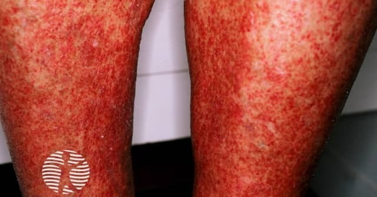 Small vessel vasculitis image