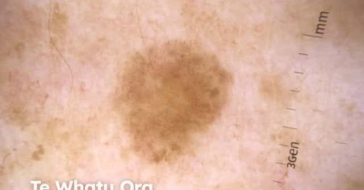 DermNet® - Solar lentigo image