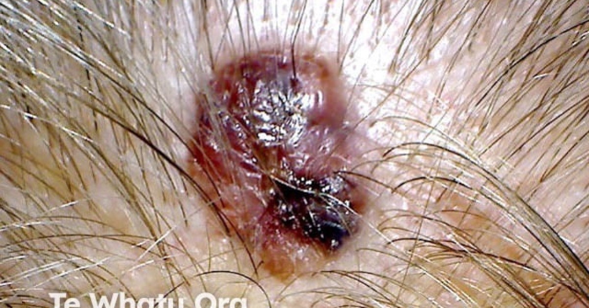 Spindle cell melanoma image