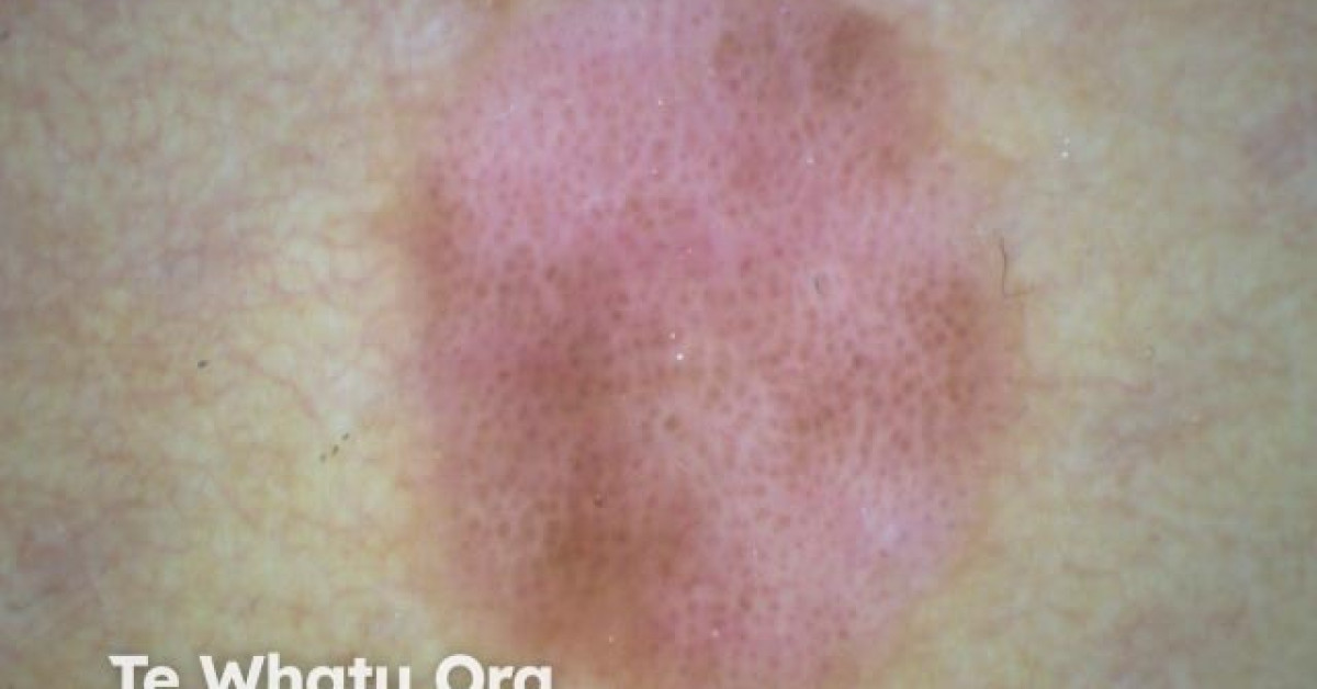 Spitz naevus, unpolarised view image