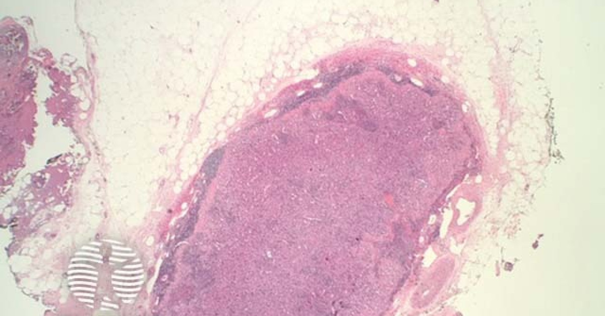 Splenosis pathology image