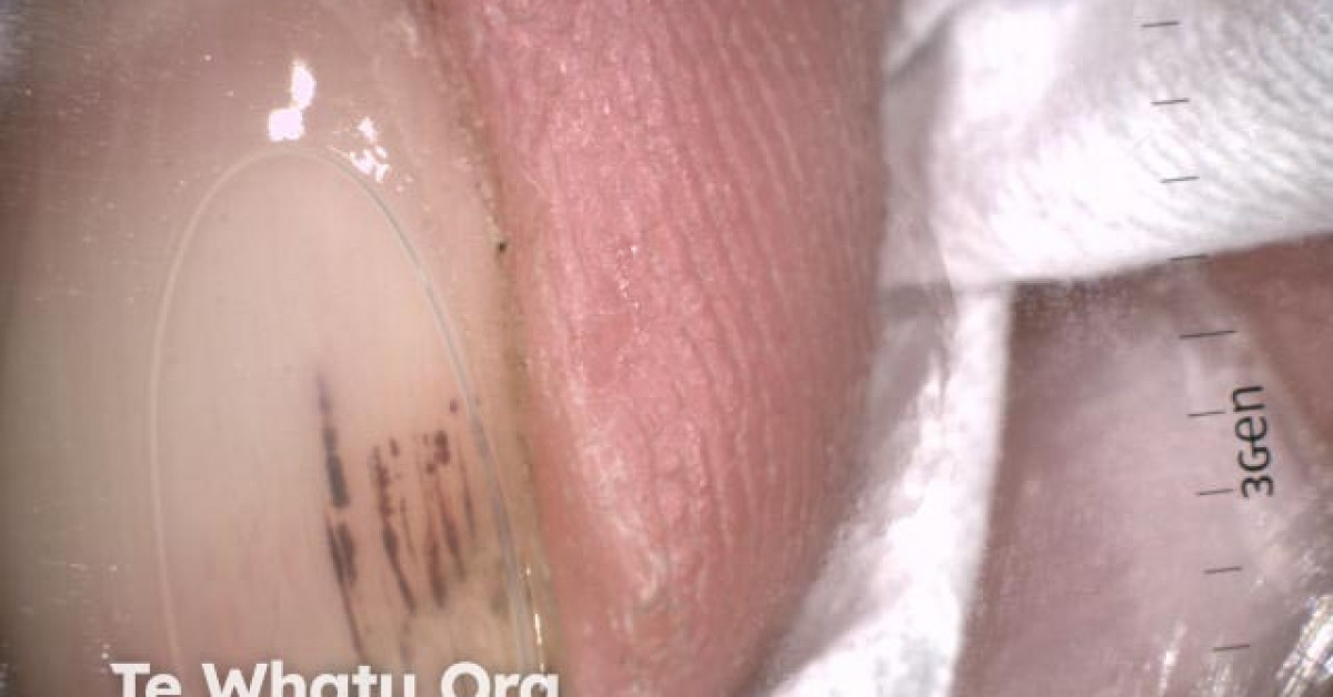 Splinter haemorrhage dermoscopy image