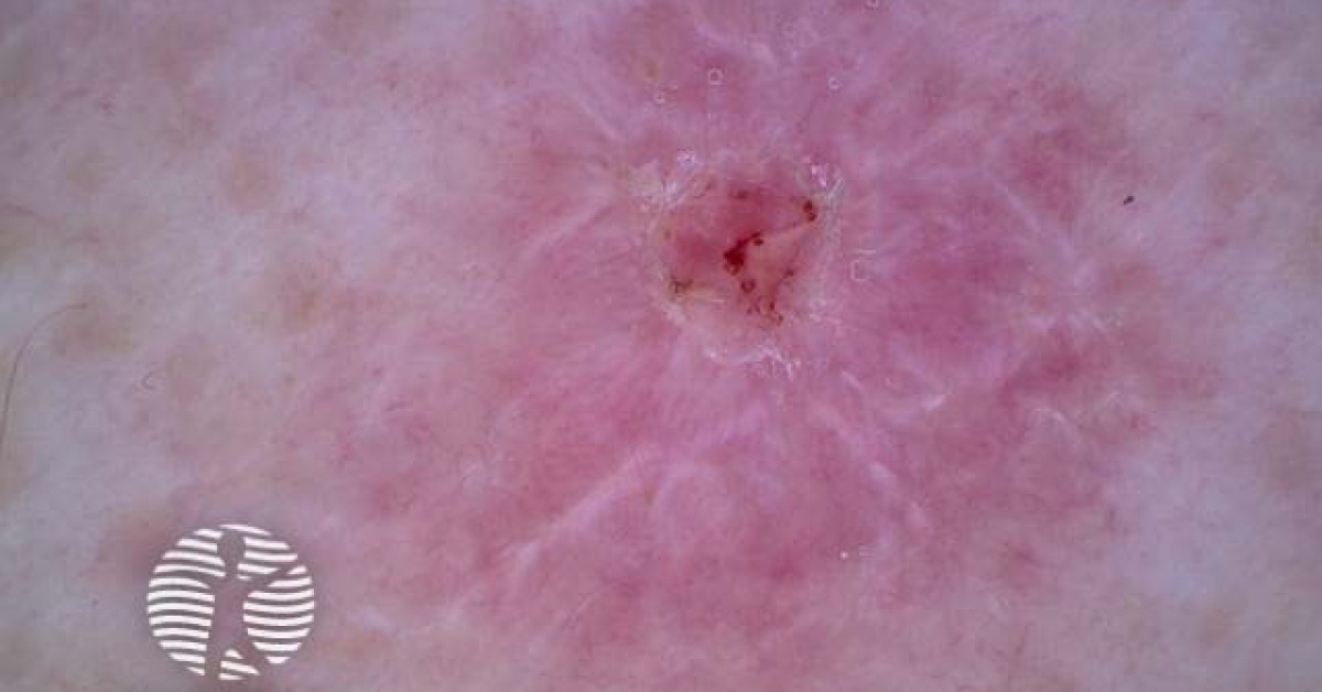 Squamous cell carcinoma polarised dermoscopy view image