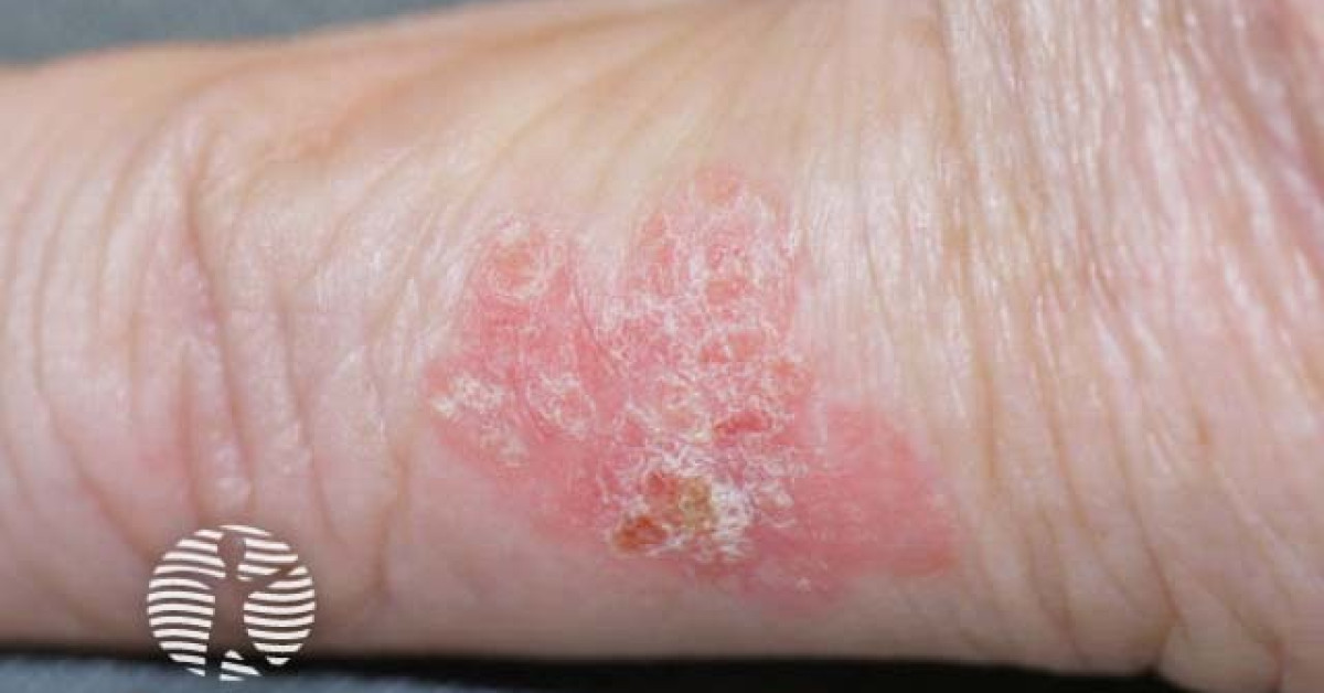 Squamous cell carcinoma in situ image