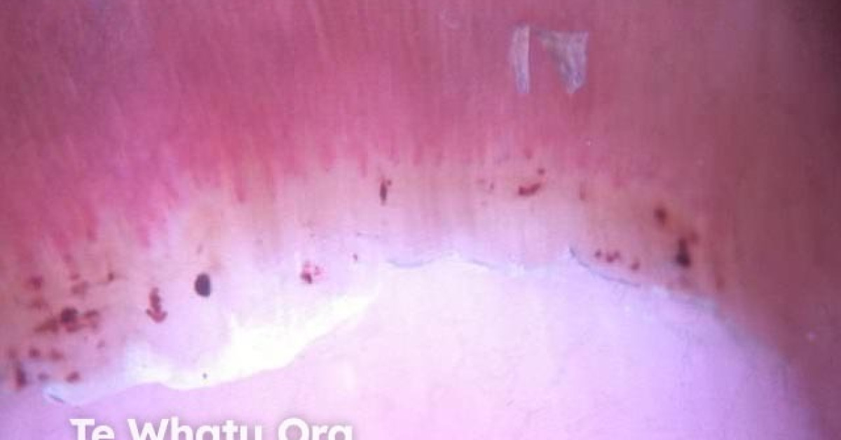 Nail fold capillaries in systemic sclerosis image